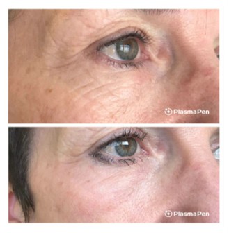 Plasma Pen (Fibroblasting) - Physical and Aesthetic Medicine | Lima, OH ...